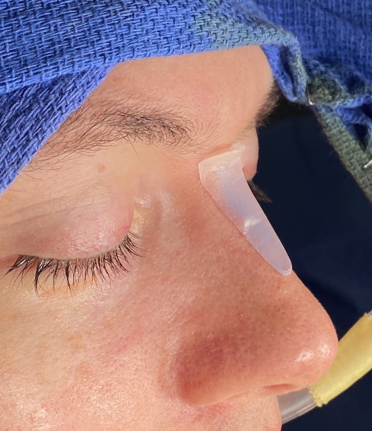 custom nasal implant placement wide view Dr Barry Eppley - Explore ...