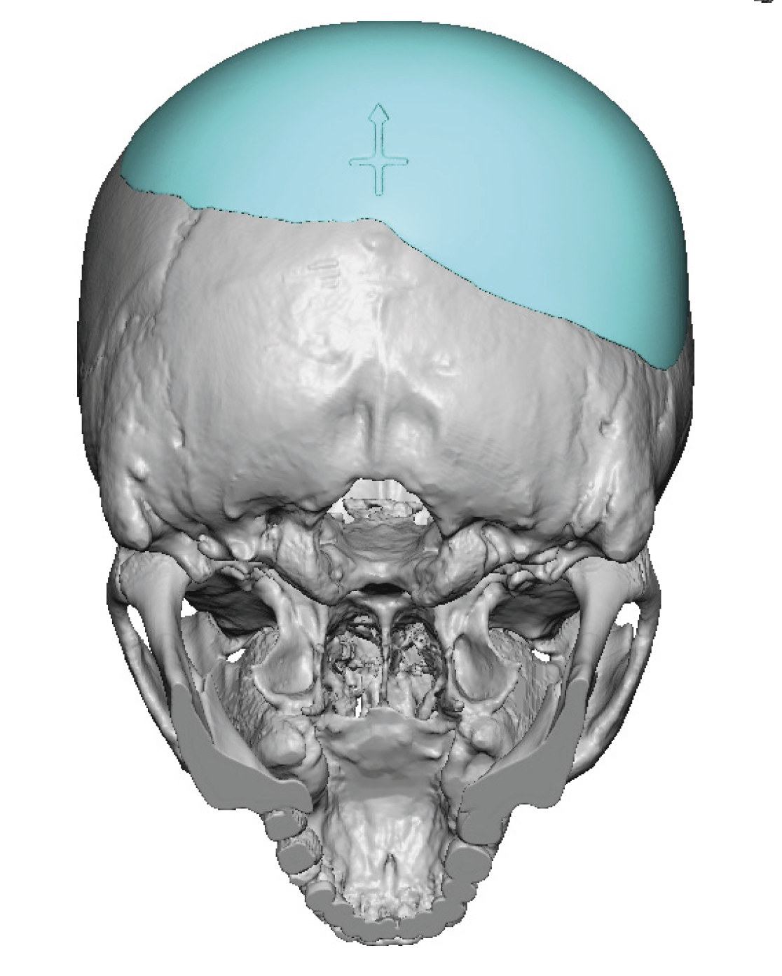 Plastic Surgery Case Study - Why Bone Cements Are Inferior to Custom ...