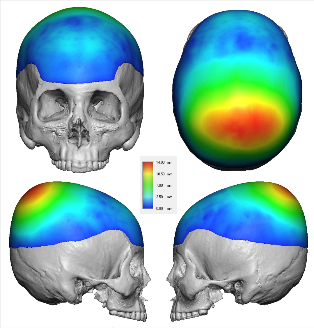 Plastic Surgery Case Study - Two Stage Aesthetic Skull Augmentation ...