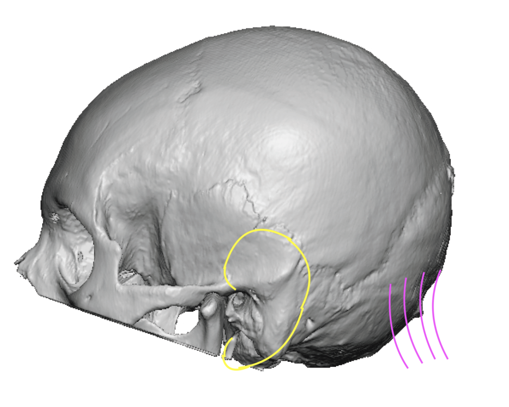 Plastic Surgery Case Study - Low Back of the Head Custom Skull Implant ...