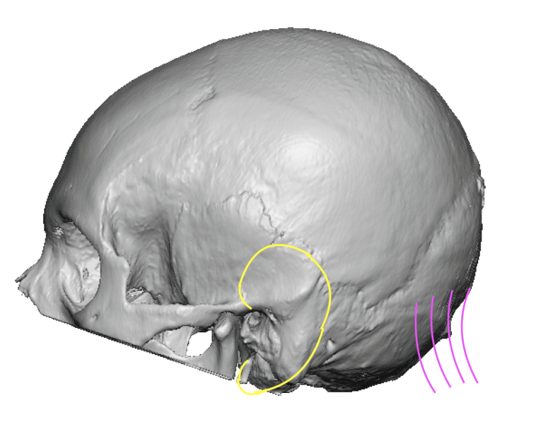 Plastic Surgery Case Study - Low Back of the Head Custom Skull Implant ...