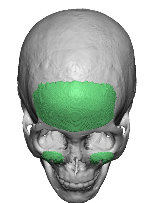 female 3D skull CT scan top view Dr Barry Eppley - Explore Plastic Surgery