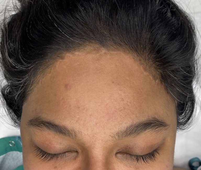 Plastic Surgery Case Study - Custom Two-Piece Frontal Skull Implant for ...