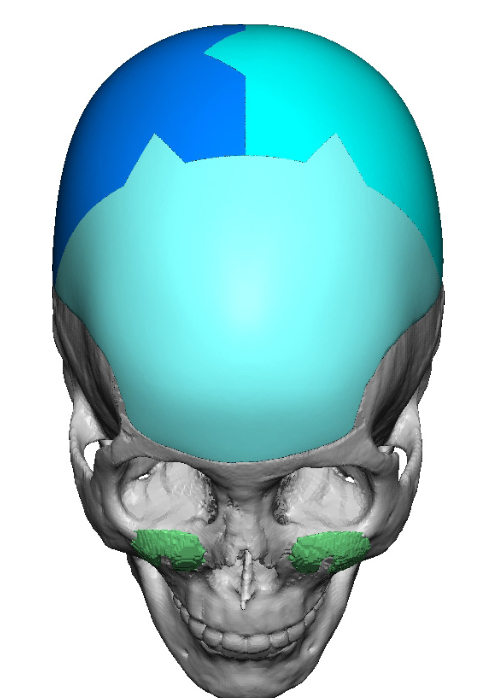 Plastic Surgery Case Study - Two Stage Aesthetic Skull Augmentation ...
