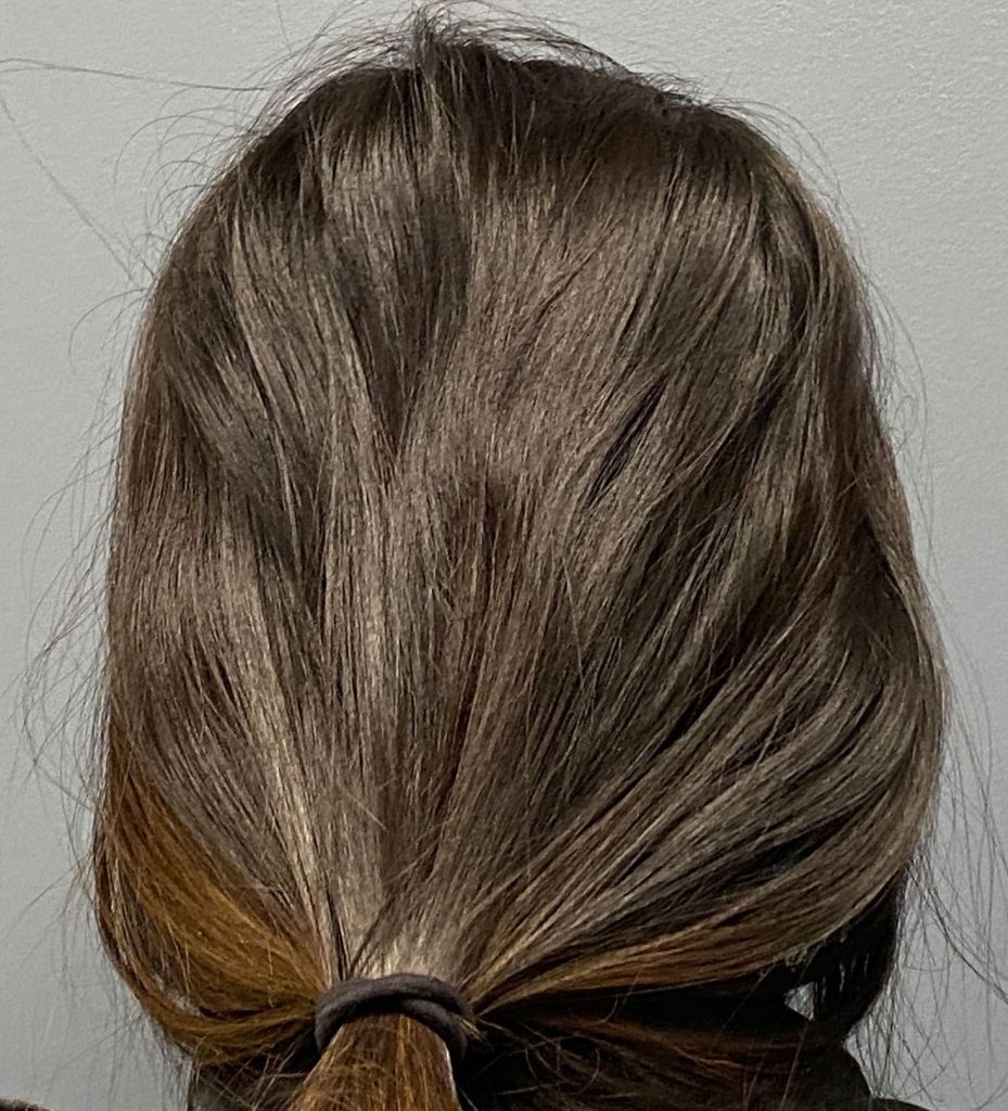 Plastic Surgery Case Study - Two Stage Aesthetic Skull Augmentation ...