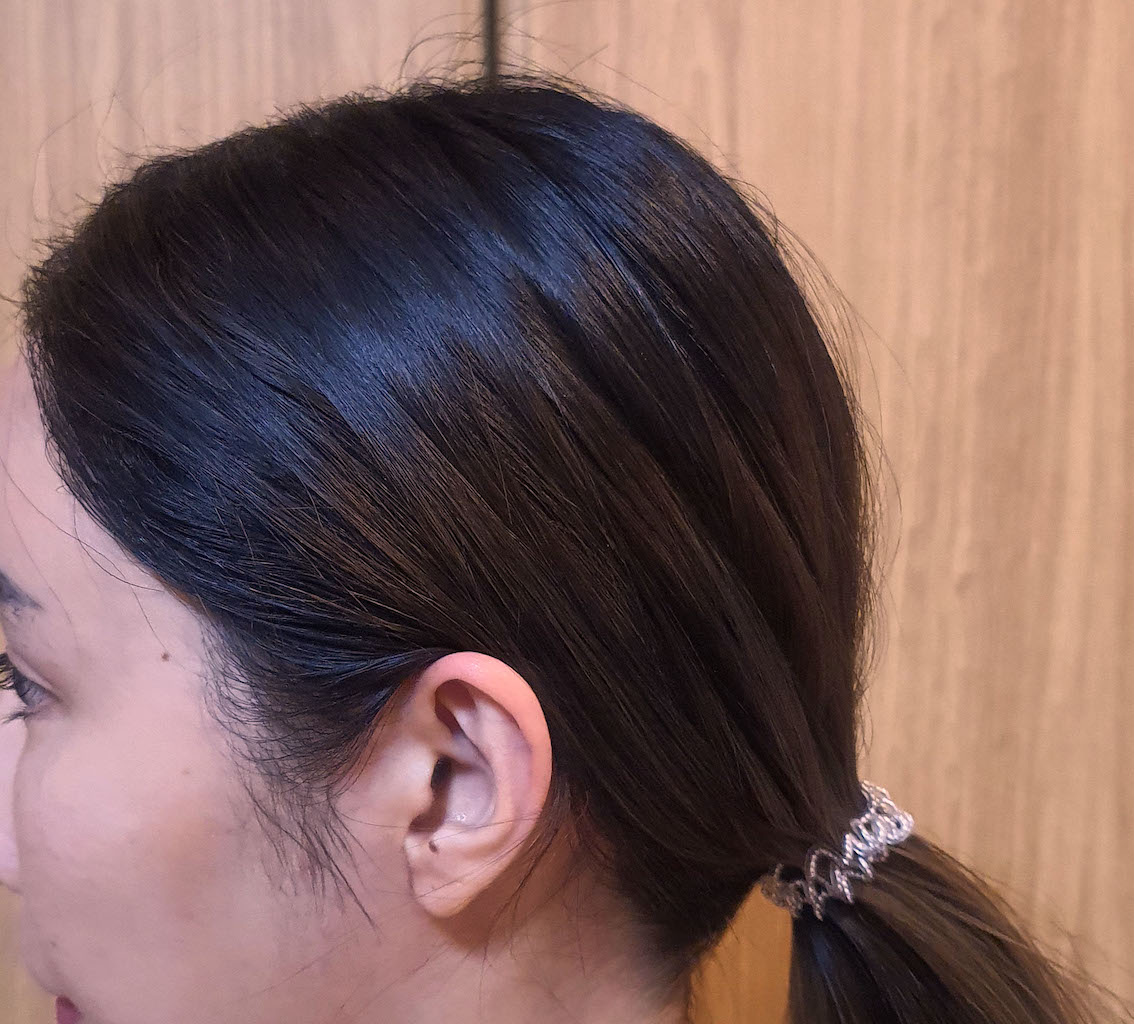 female scalp expansion side 1 Dr Barry Eppley - Explore Plastic Surgery