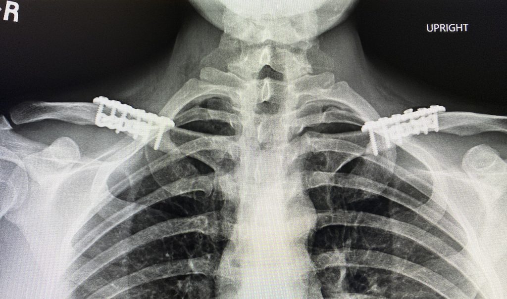 female shoulder red postop x-ray - Explore Plastic Surgery