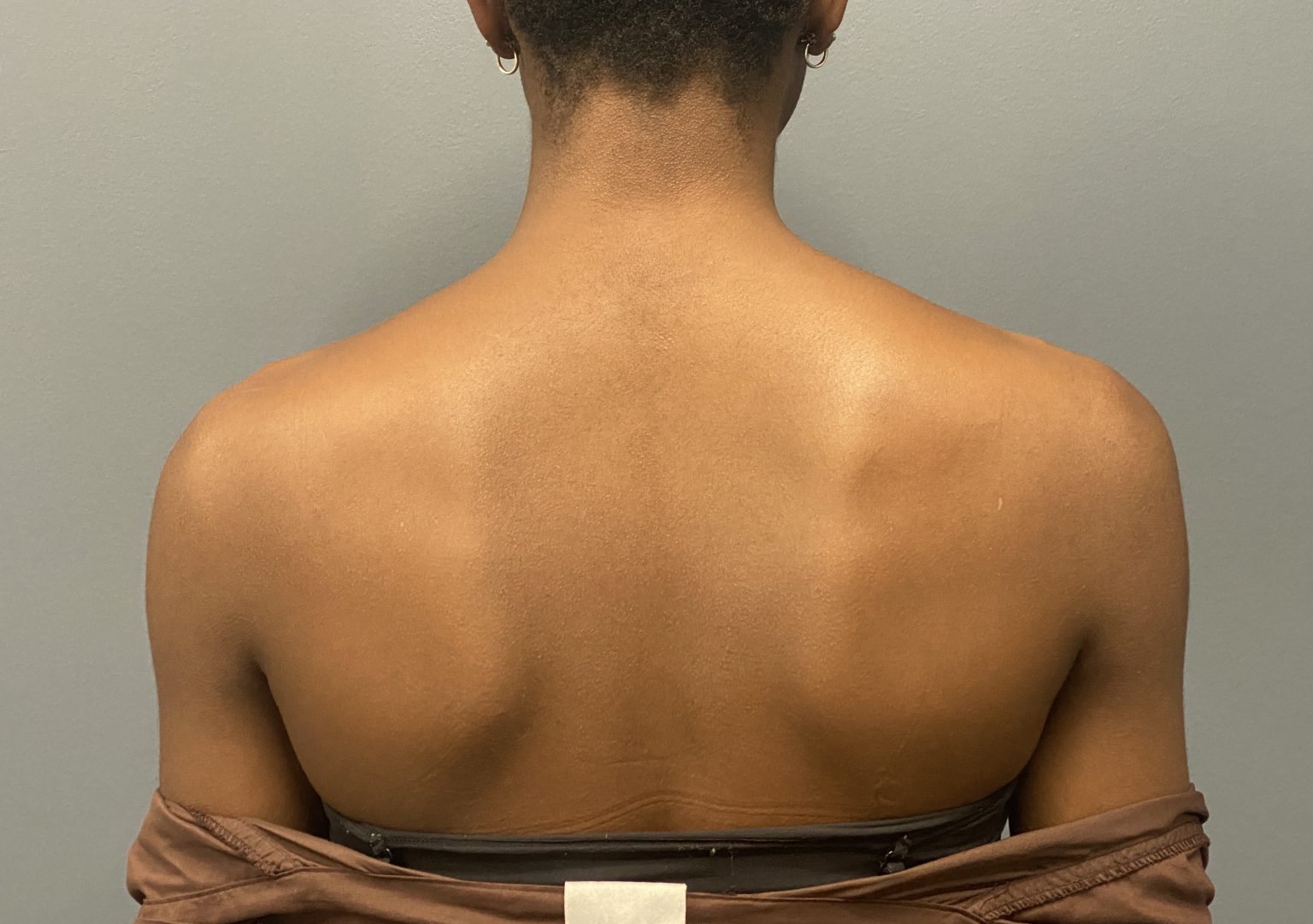 Plastic Surgery Case Study - Differing Bone Cross-Sectional Thicknesses ...