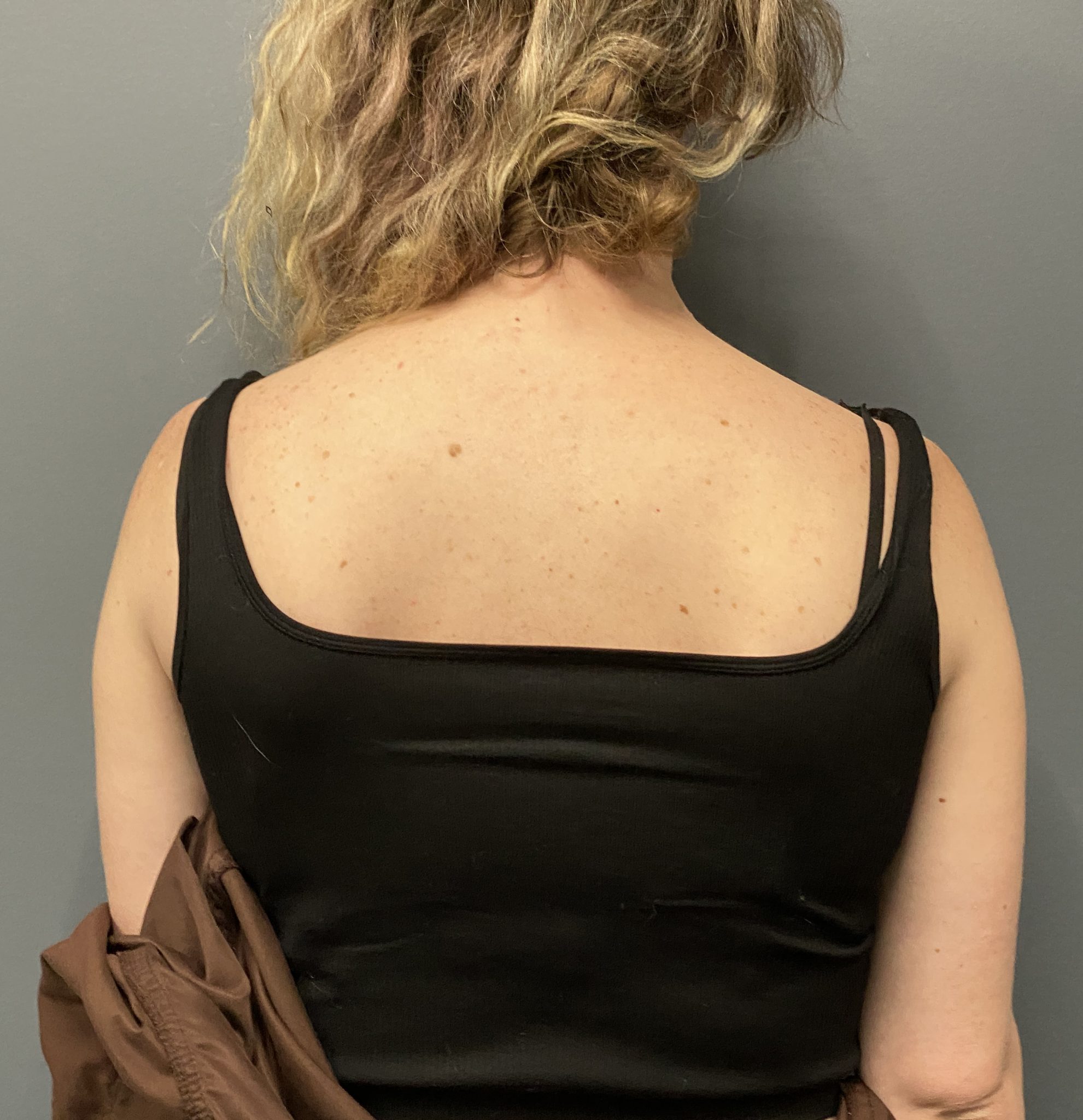 Plastic Surgery Case Study - The Effects of Shoulder Reduction in Both ...