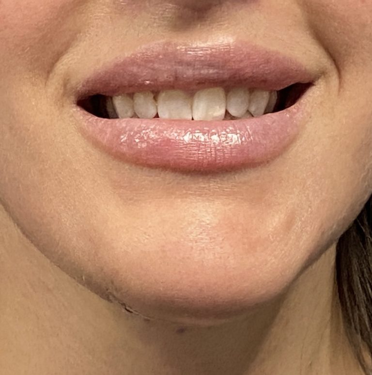 Plastic Surgery Case Study - The Submental Approach to Hyperdynamic ...