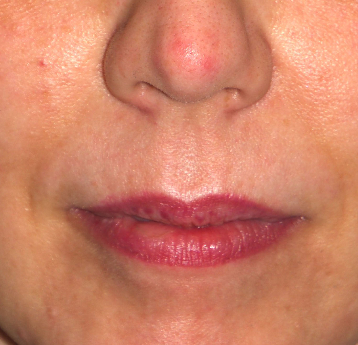 female upper lip reshaping front 1 Dr Barry Eppley - Explore Plastic ...