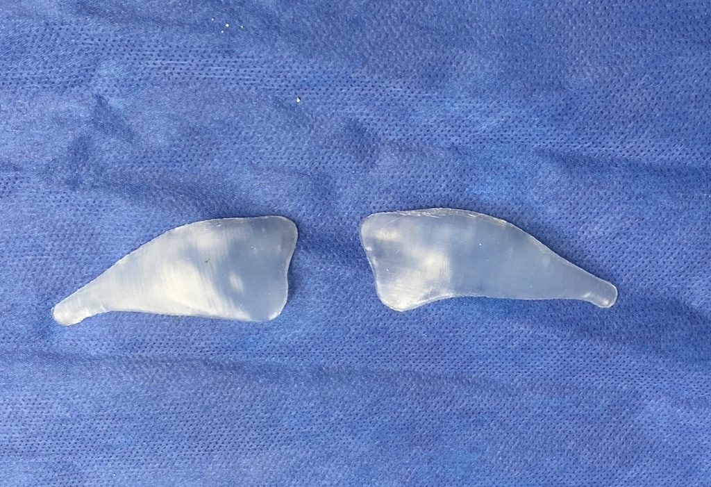 Understanding the Anatomic Basis of the High Cheekbone Implant ...