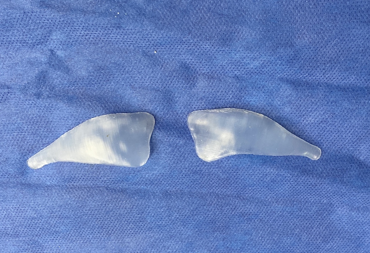 Understanding the Anatomic Basis of the High Cheekbone Implant ...