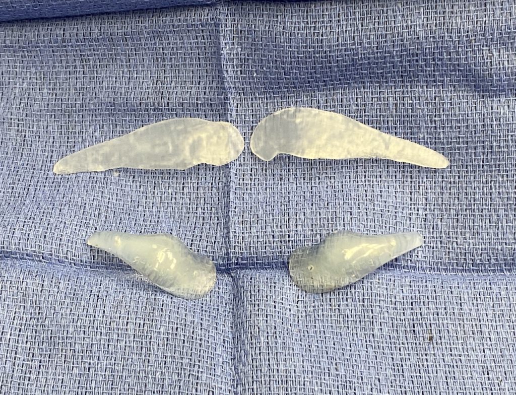 Plastic Surgery Case Study - Achieving An Improved Cheek Implant ...