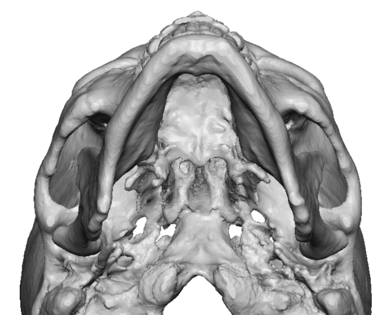 The Anatomy Behind Proper Jaw Angle Implant Positioning - Explore ...