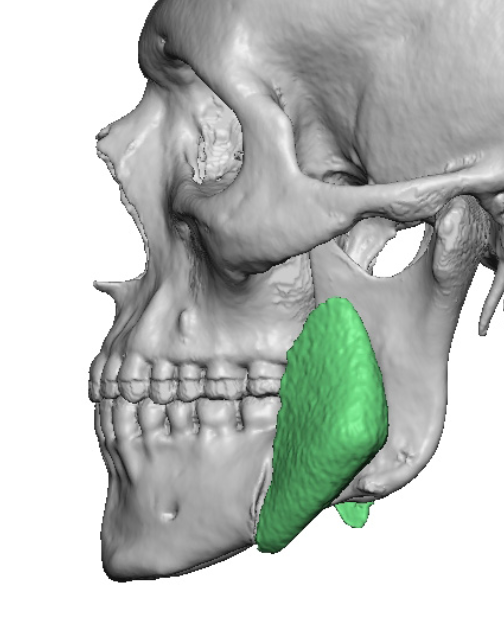 The Anatomy Behind Proper Jaw Angle Implant Positioning - Explore ...