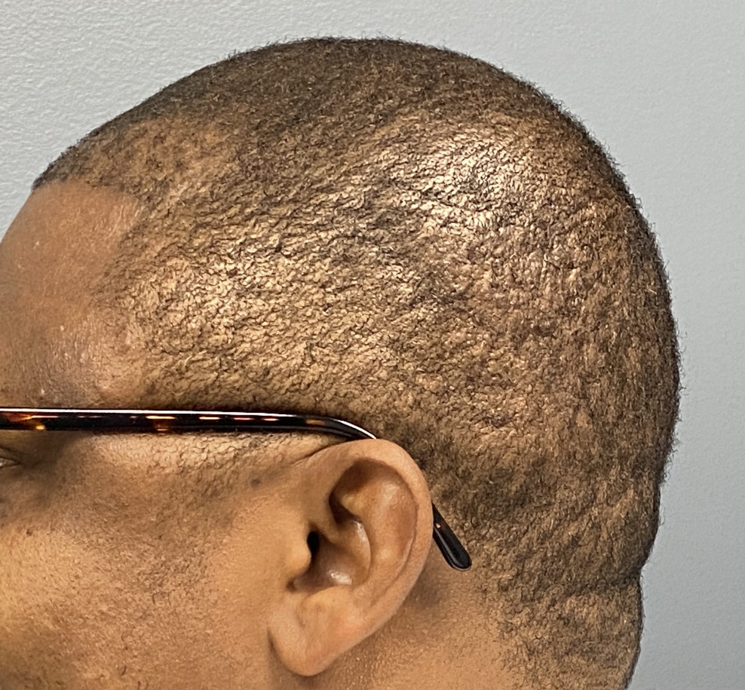 Plastic Surgery Case Study - Low Back of the Head Custom Skull Implant ...