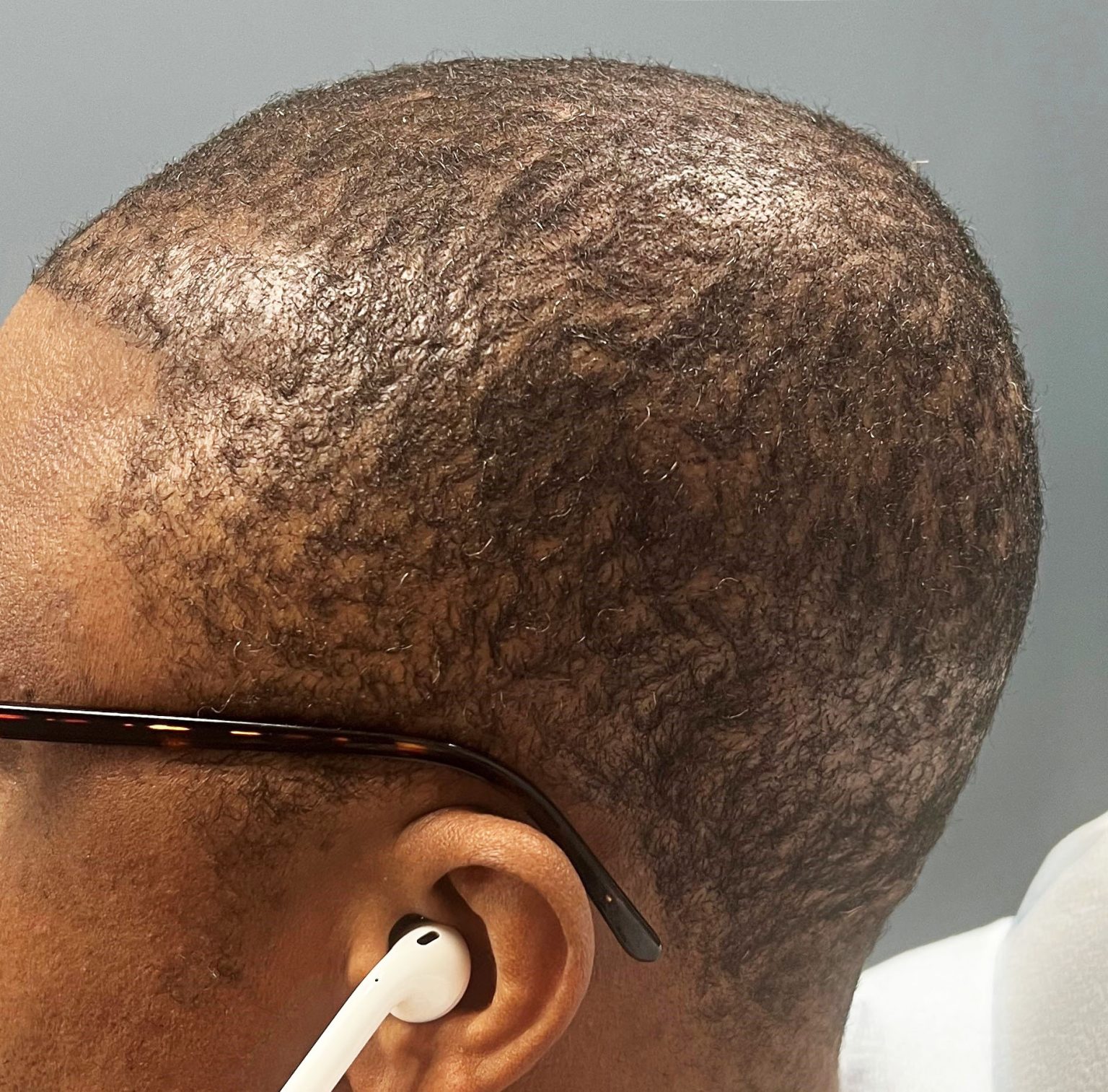 Plastic Surgery Case Study - Low Back of the Head Custom Skull Implant ...