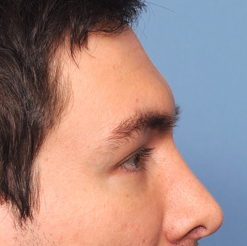 Plastic Surgery Case Study - Long Term Result in Male Brow Bone ...