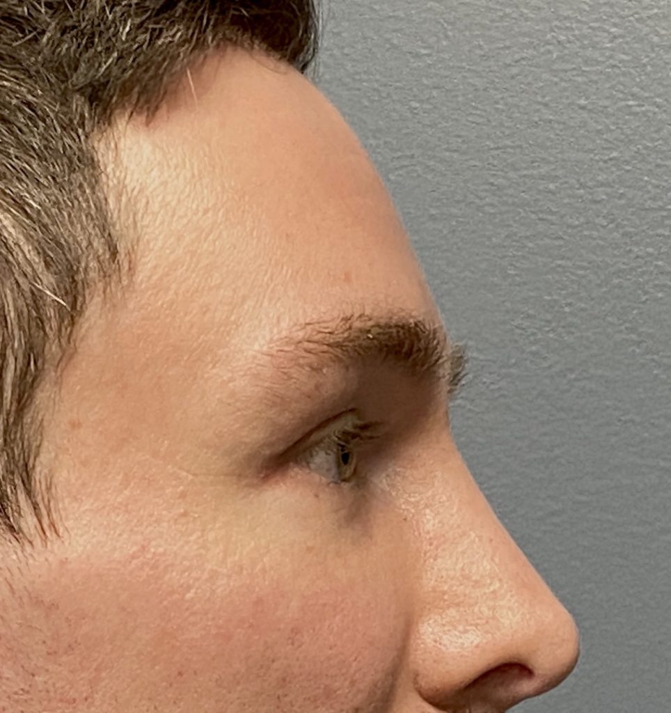 Plastic Surgery Case Study - Long Term Result in Male Brow Bone ...
