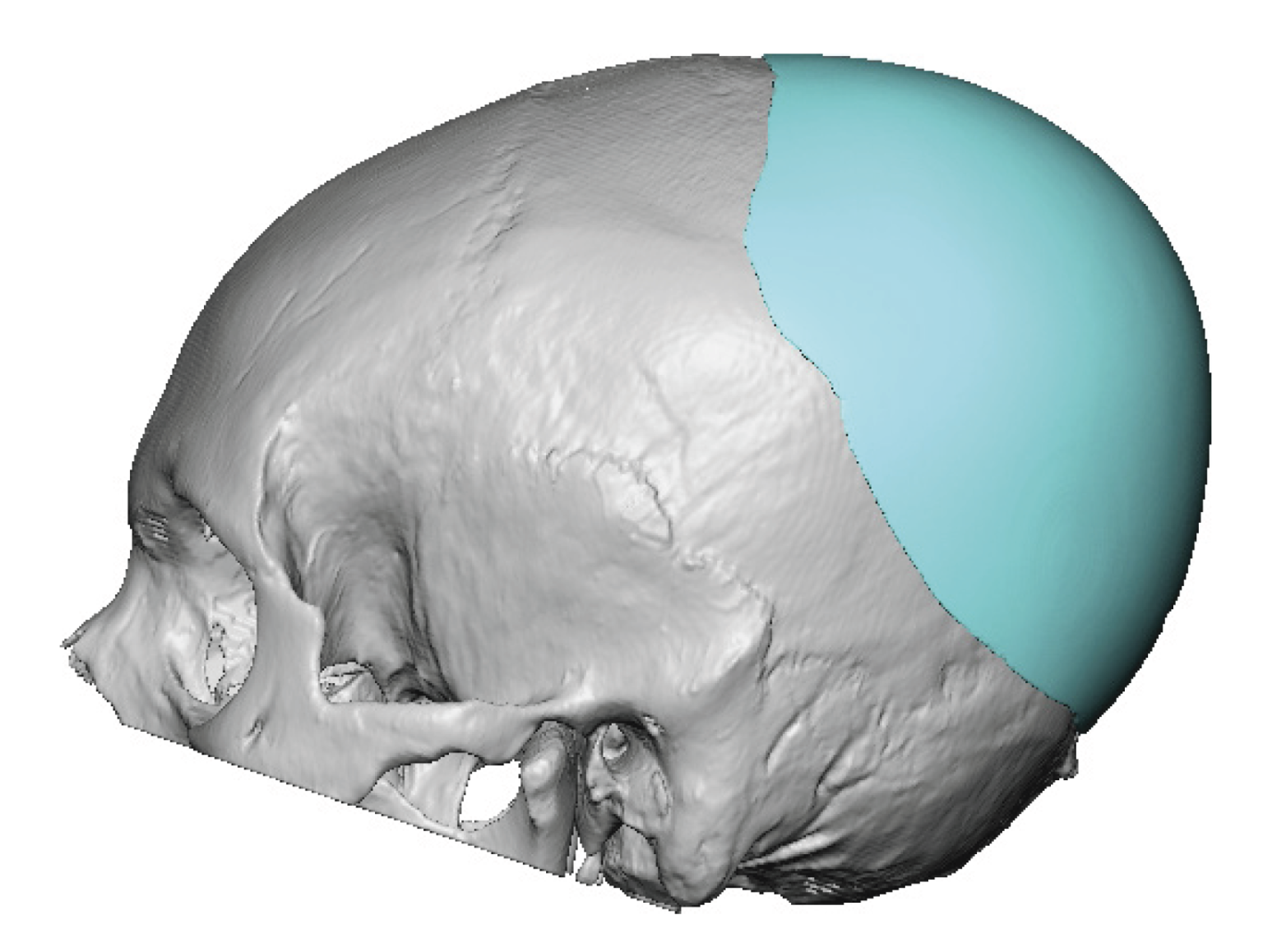 Plastic Surgery Case Study - Low Back of the Head Custom Skull Implant ...