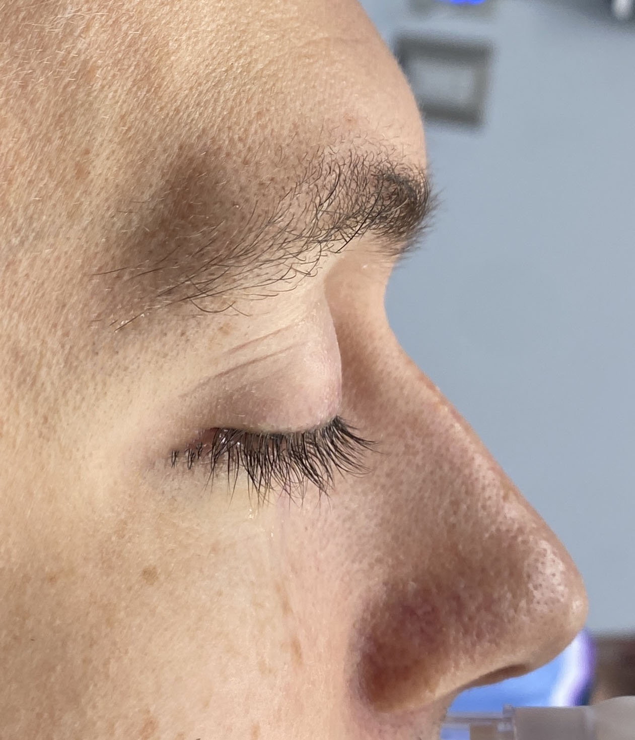 Plastic Surgery Case Study - Custom Nasal Implant for Improved ...