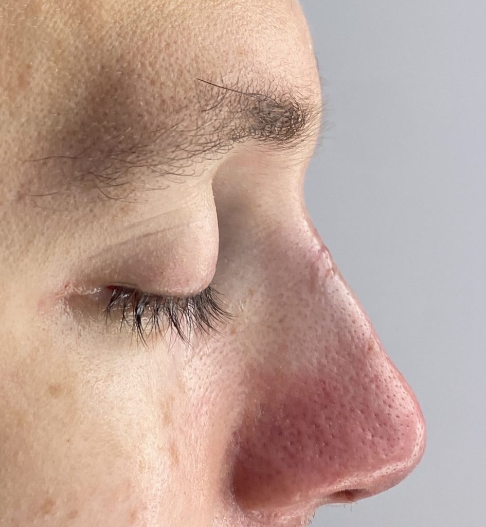 Plastic Surgery Case Study - Custom Nasal Implant for Improved ...