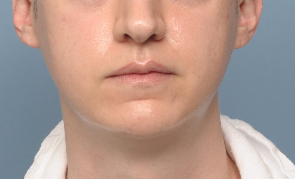 male jawline implant front 1 Dr Barry Eppley copy - Explore Plastic Surgery
