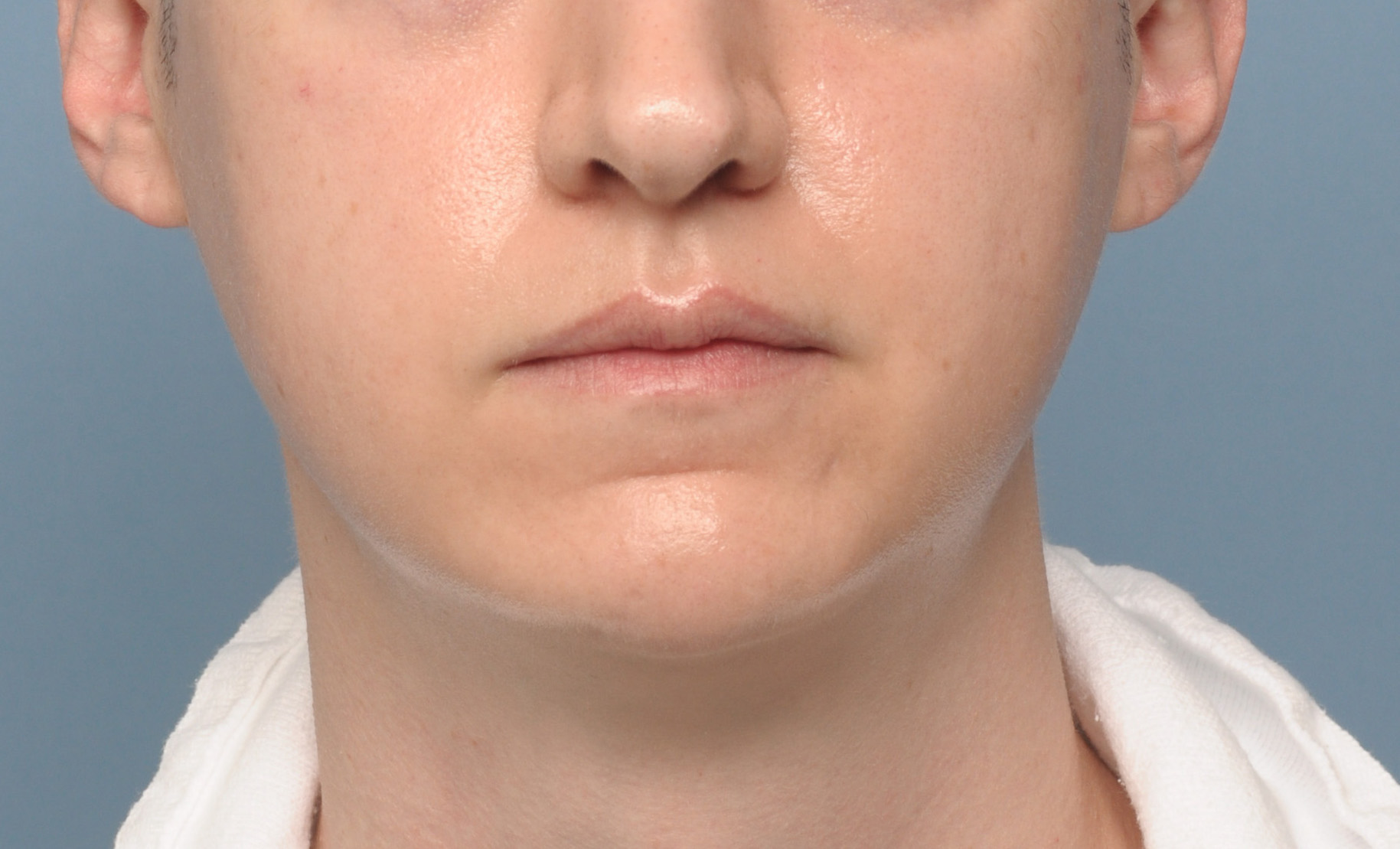 Plastic Surgery Case Study - Male Custom Jawline Implant Design and ...