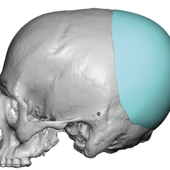 skull reshaping Archives - Explore Plastic Surgery