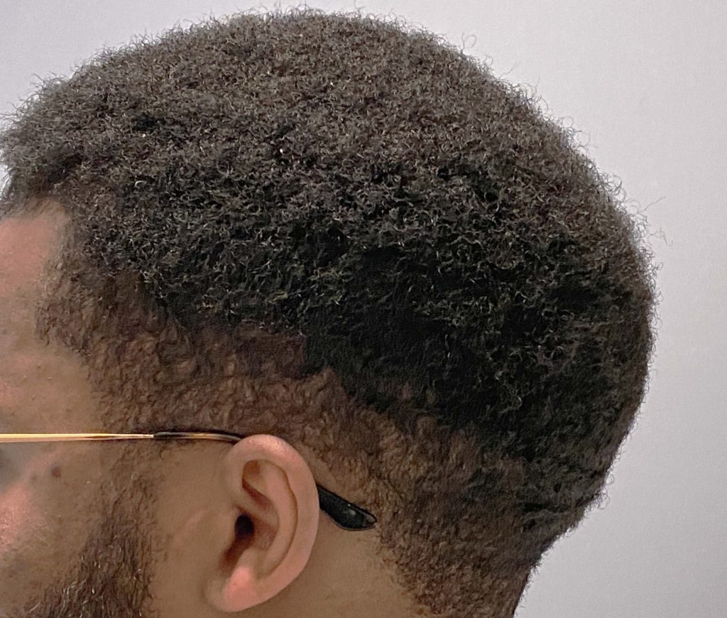 Plastic Surgery Case Study - Bony Reduction of the Congenital Occipital ...