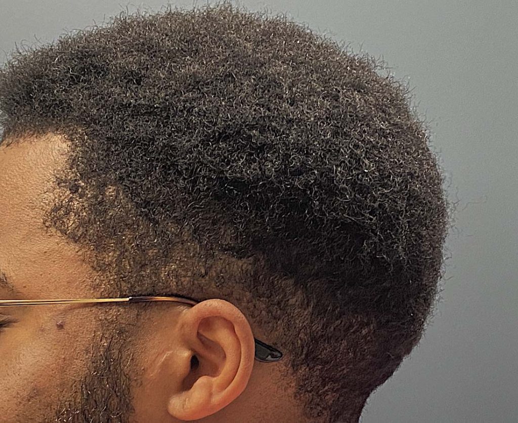 Plastic Surgery Case Study - Bony Reduction of the Congenital Occipital ...