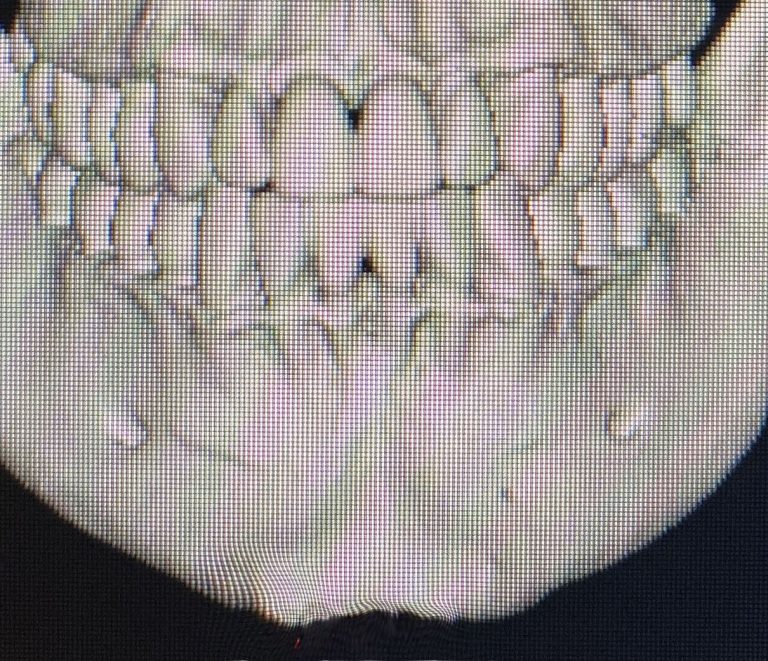 Plastic Surgery Case Study - Male Horizontal Chin Reduction - Explore ...