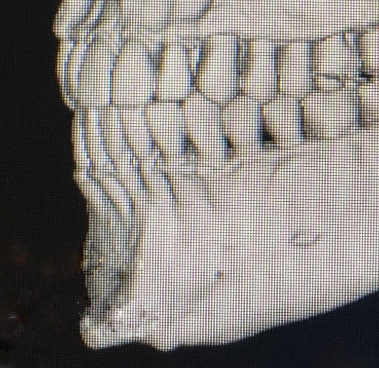 Plastic Surgery Case Study - Male Horizontal Chin Reduction - Explore ...