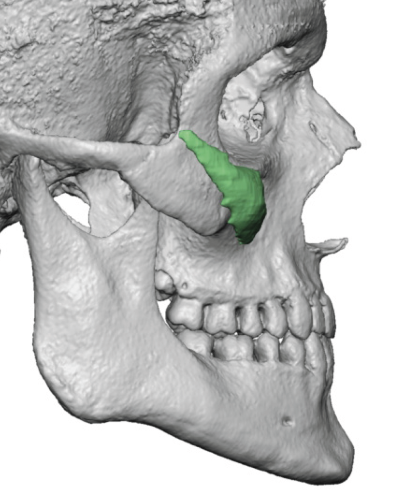 male submalar cheek implants 3D CT scan side view Dr Barry Eppley ...