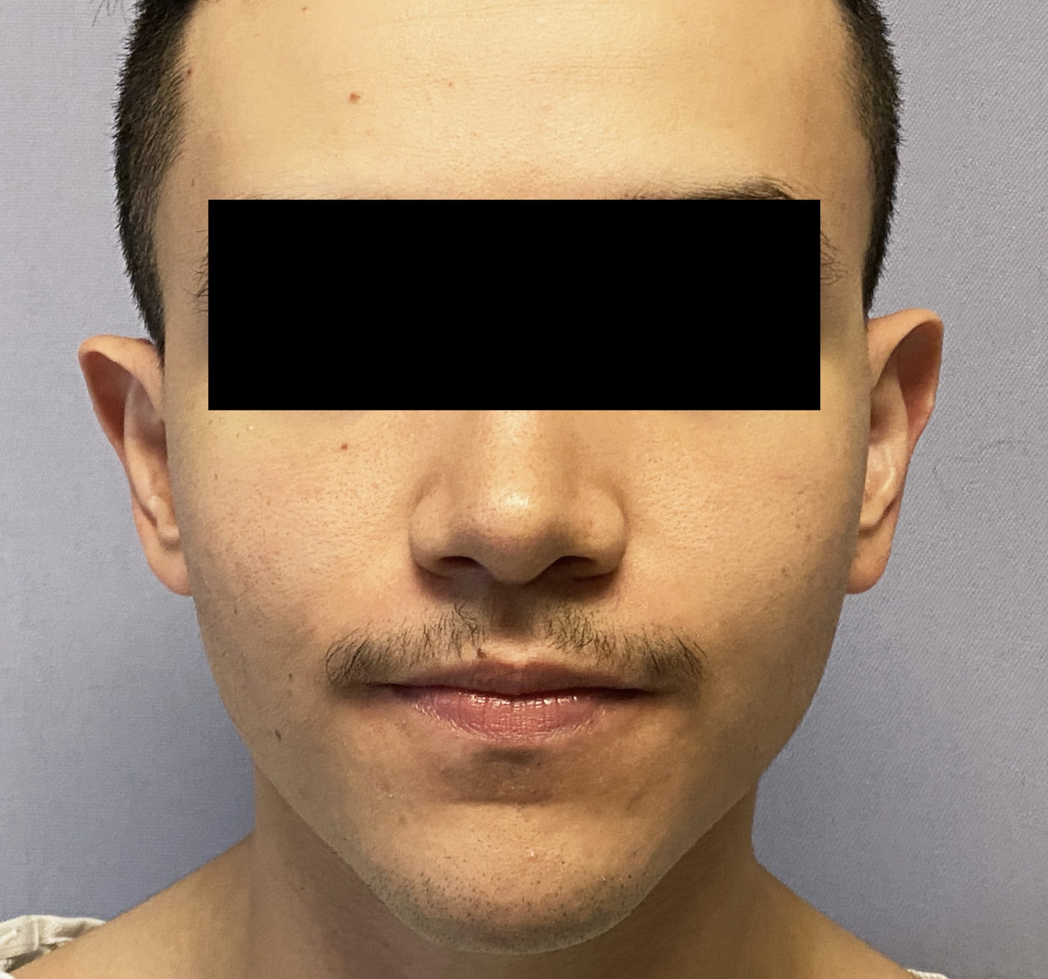 Plastic Surgery Case Study - Long Term Results of Subtotal Otoplasty ...