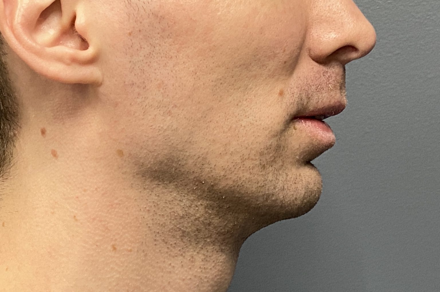 Plastic Surgery Case Study - Lengthening the Lower Third of the Face ...