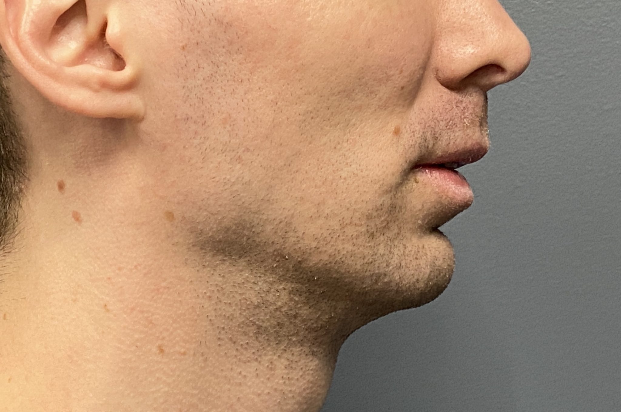 Plastic Surgery Case Study - Lengthening the Lower Third of the Face ...