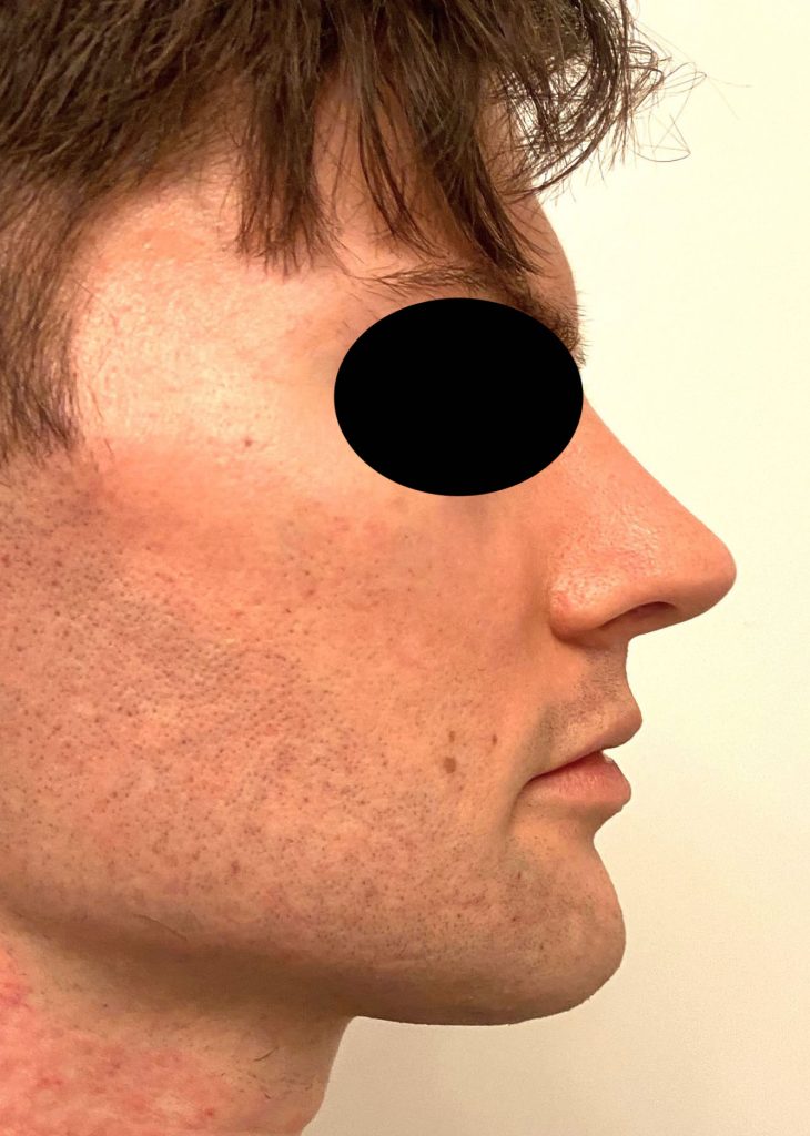 male vertical chin lengthening result side view 2 Dr Barry Eppley ...