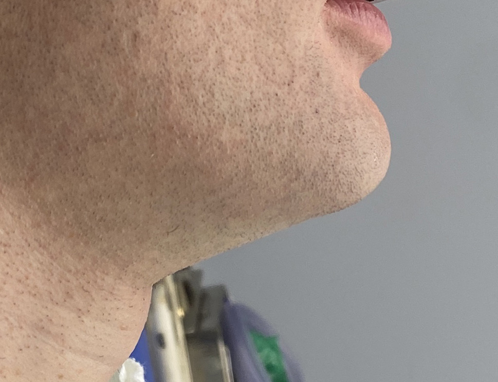 Plastic Surgery Case Study - The Male Vertical Lengthening Chin ...