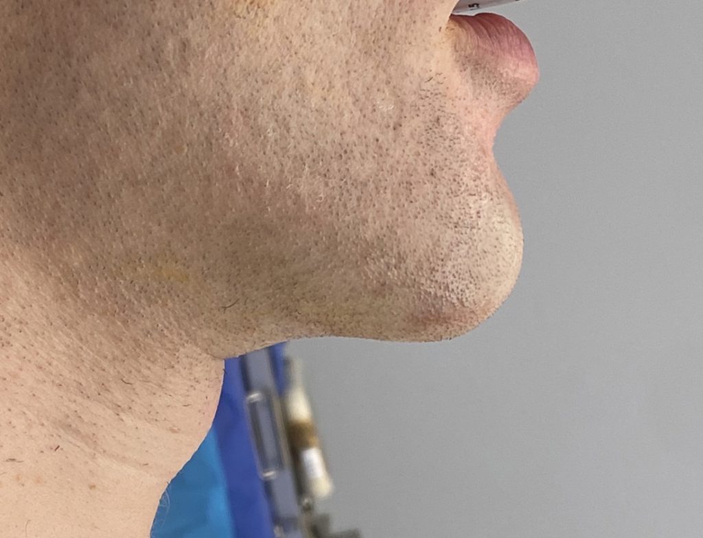 Plastic Surgery Case Study - The Male Vertical Lengthening Chin ...