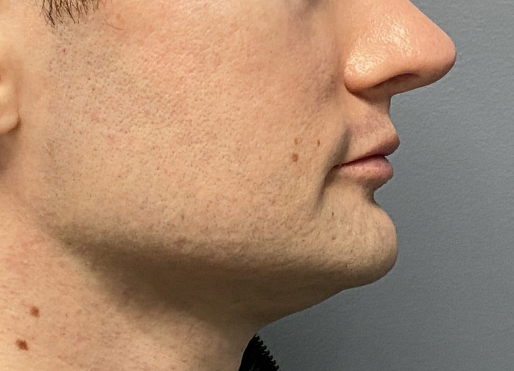 male vertical short chin side view Dr Barry Eppley - Explore Plastic ...