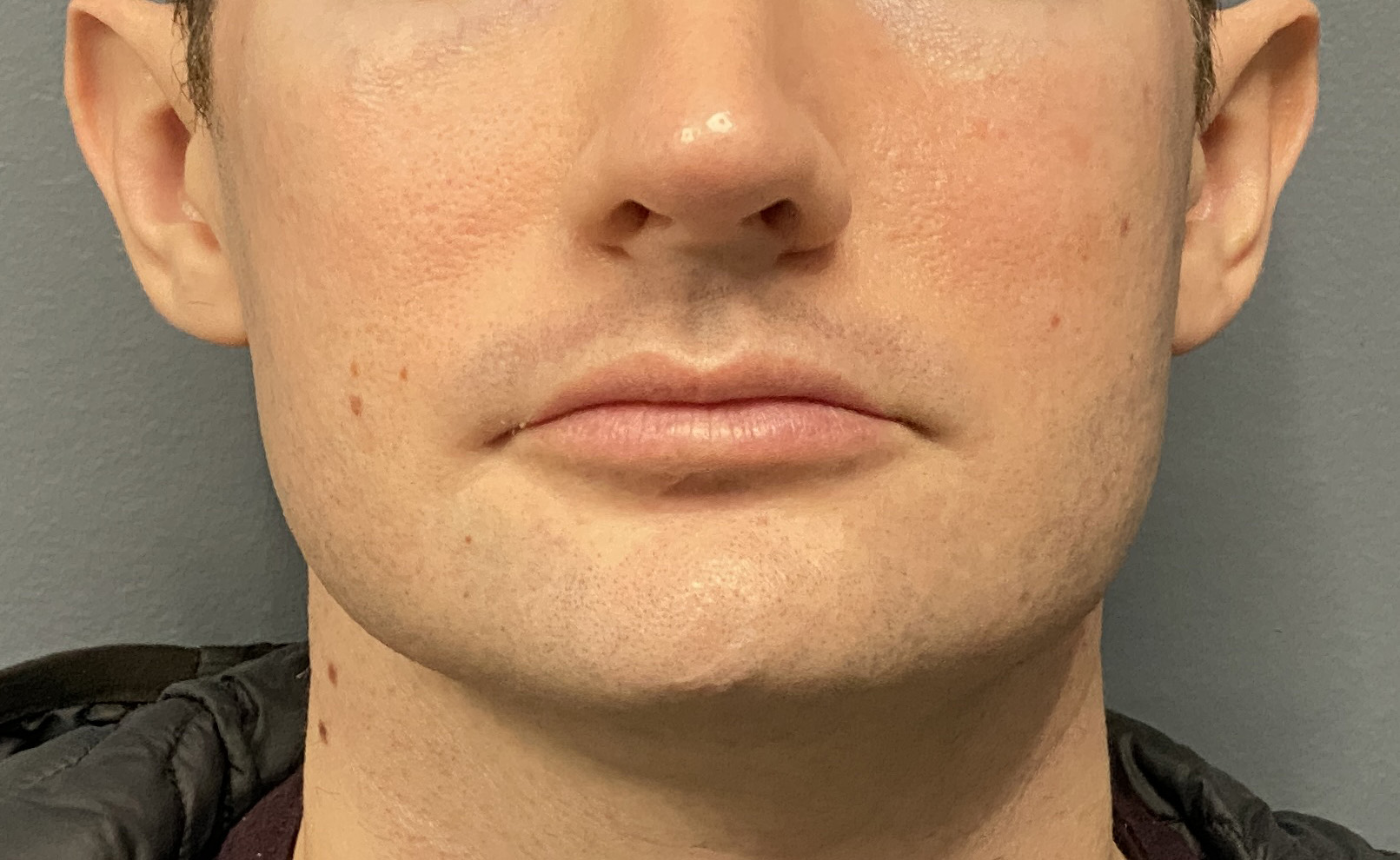Plastic Surgery Case Study - The Male Vertical Lengthening Chin ...