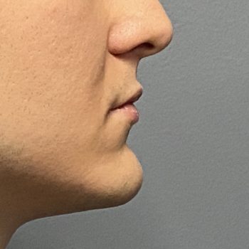 chin reduction Archives - Explore Plastic Surgery