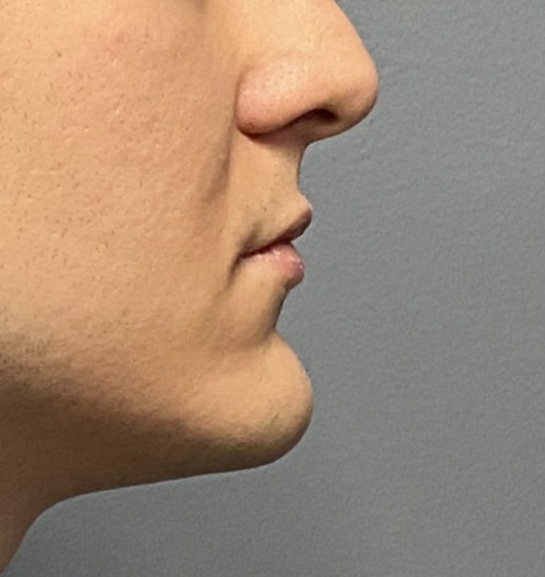 Plastic Surgery Case Study - Male Horizontal Chin Reduction - Explore ...