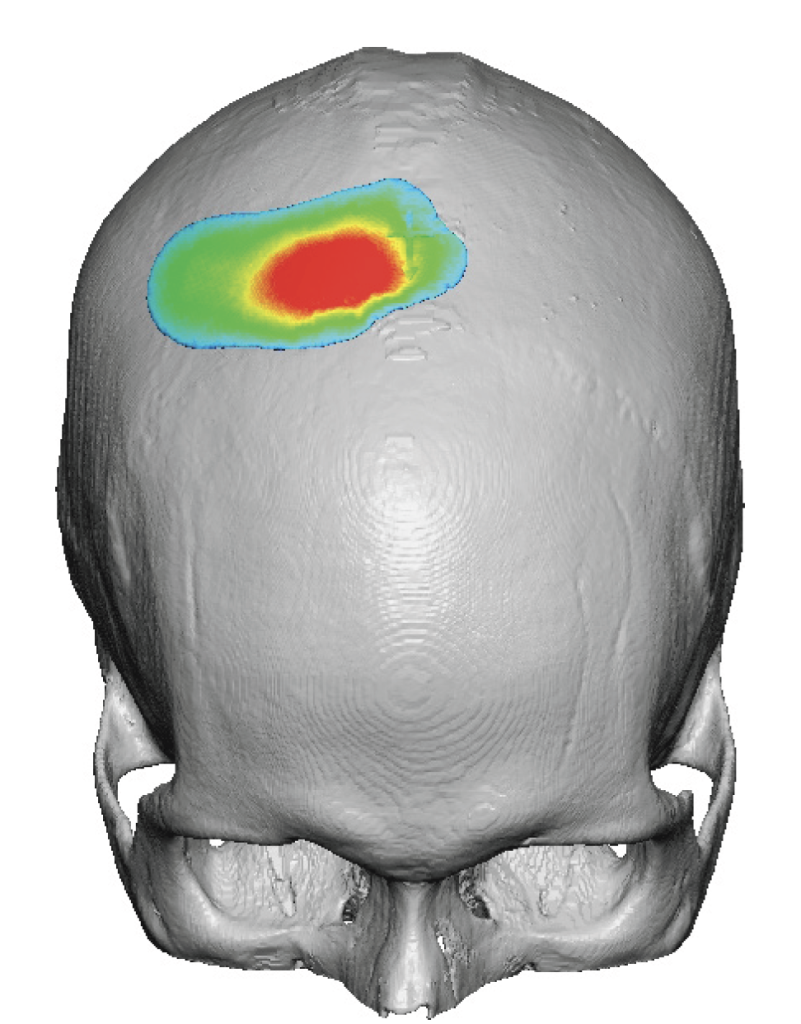 Plastic Surgery Case Study - Custom Skull Implant Correction for a ...