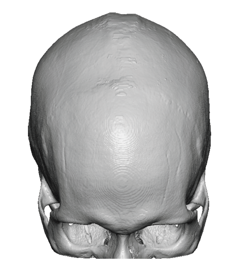 Plastic Surgery Case Study - Custom Skull Implant Correction for a ...