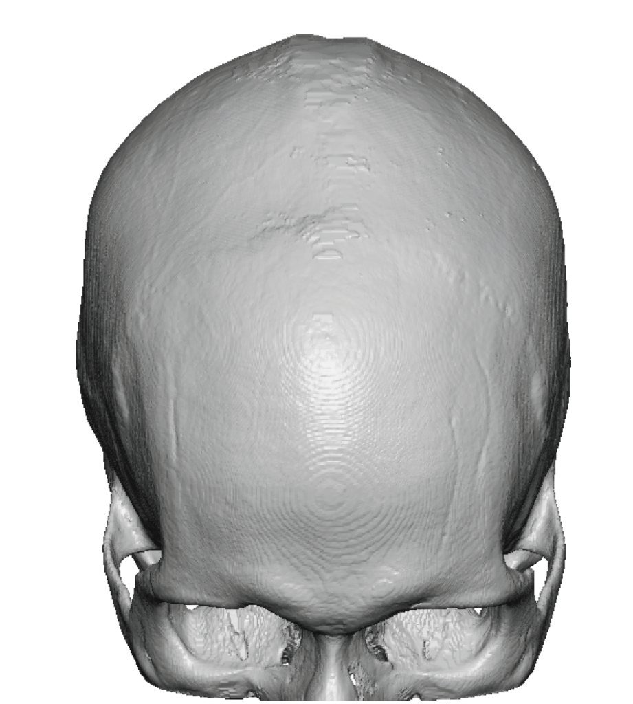 Plastic Surgery Case Study - Custom Skull Implant Correction for a ...