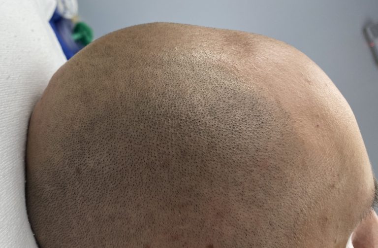 right coronal dip skull defect right side view Dr Barry Eppley ...