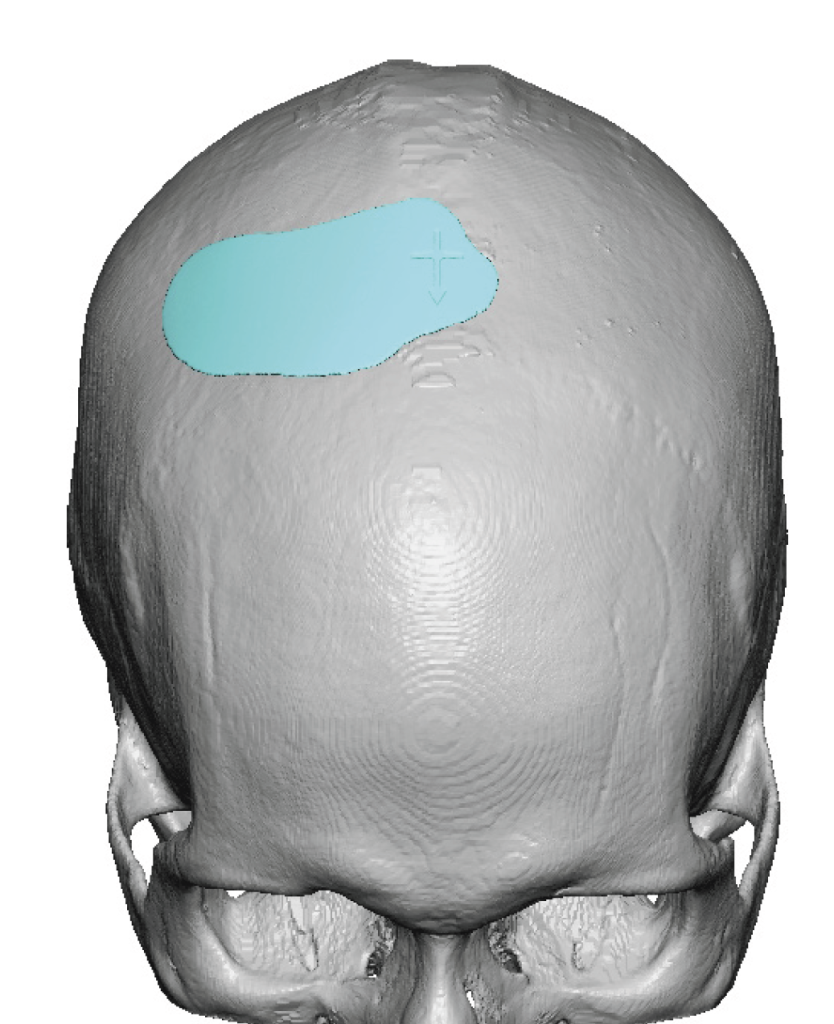 Plastic Surgery Case Study - Custom Skull Implant Correction for a ...